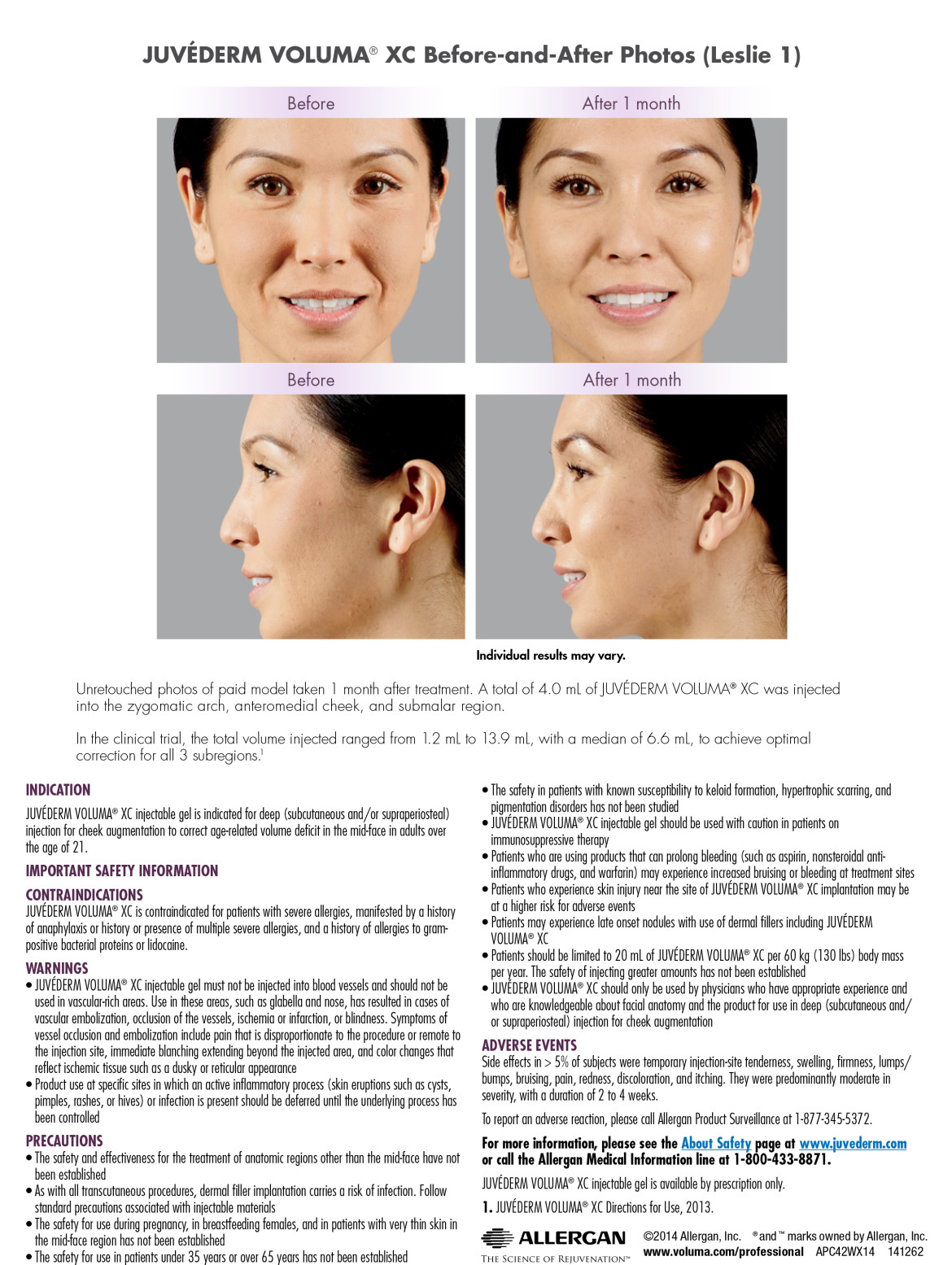Juvéderm® Voluma XC | Ferrara Dermatology
