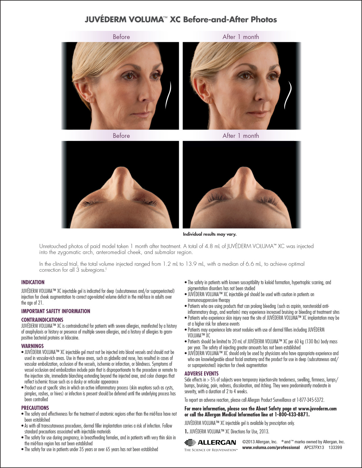 Juvéderm® Voluma XC | Ferrara Dermatology