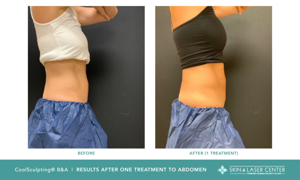 CoolSculpting Elite | Ferrara Dermatology