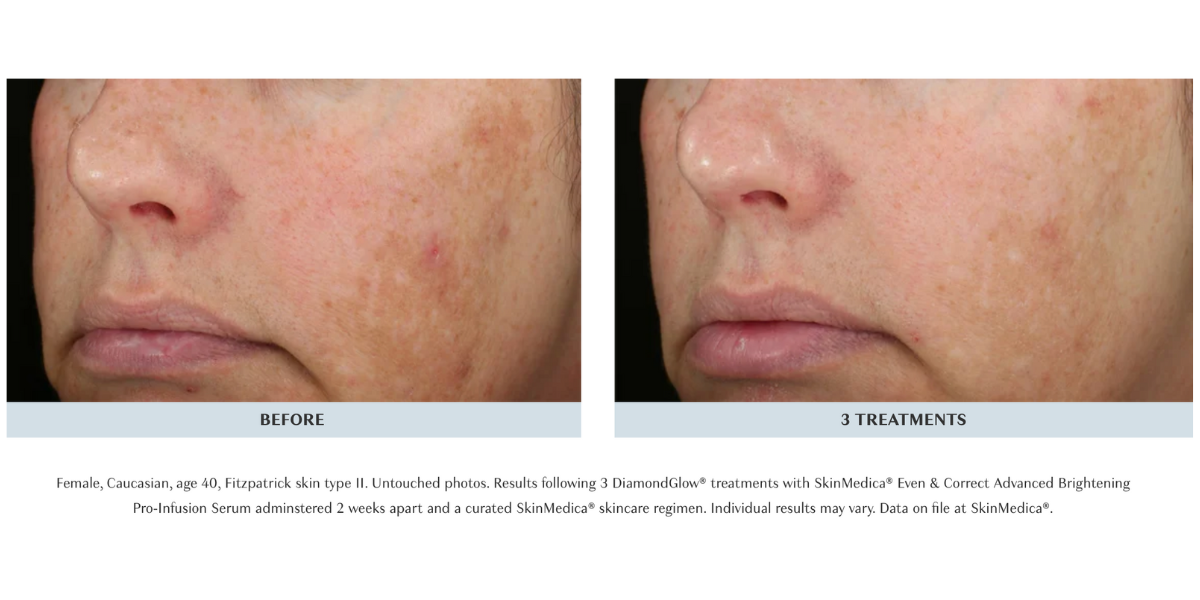 DiamondGlow Treatment: Radiant Skin Awaits | Ferrara Dermatology